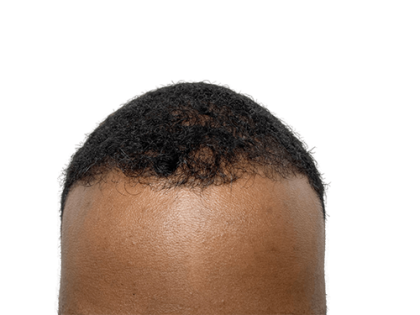 Patient #Auto Draft Hair Transplants Before and After Photos Austin ...