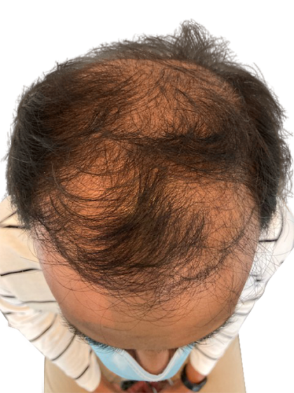 Patient 2214 Hair Transplants Before And After Photos Austin Plastic Surgery Gallery San