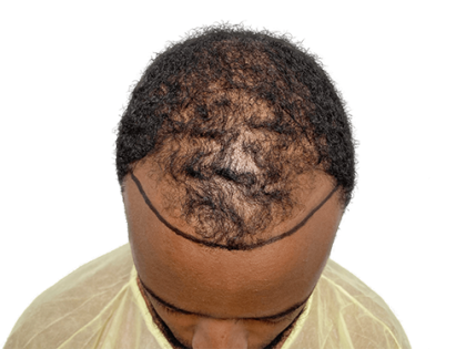 Patient #Auto Draft Hair Transplants Before and After Photos Austin ...