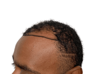 Patient #Auto Draft Hair Transplants Before and After Photos Austin ...