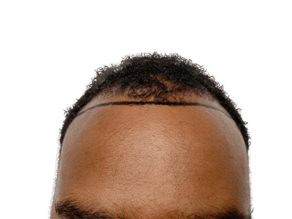 Patient #Auto Draft Hair Transplants Before and After Photos Austin ...